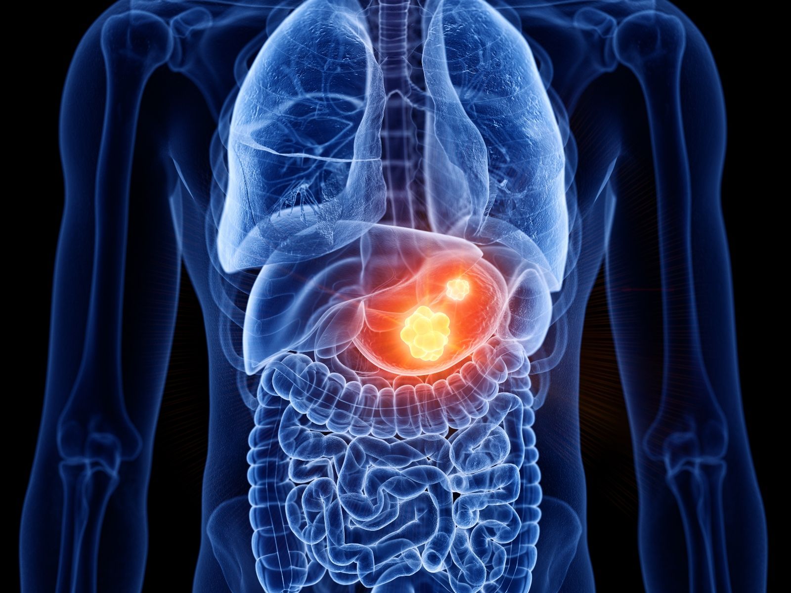 Sensitivity To Chemotherapy May Guide Treatment Of Patients With sensitivity-to-chemotherapy-may-guide-treatment-of-patients-with